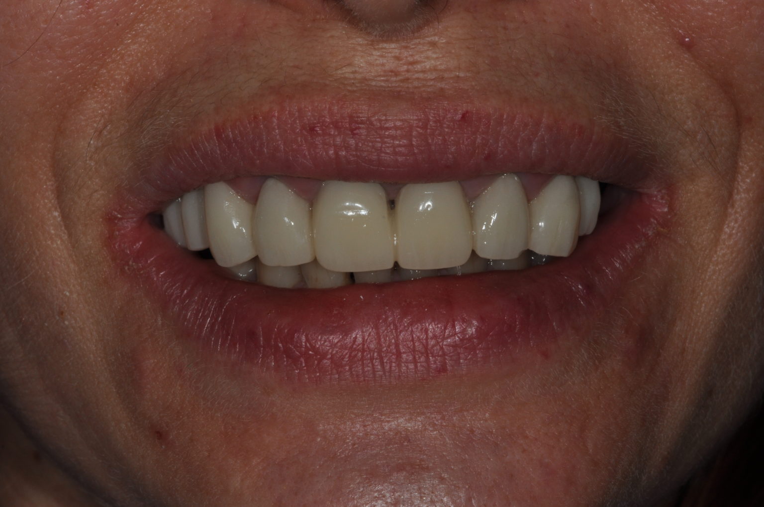 Denti fissi in 10 ore google - Dott. Marco Chiellini